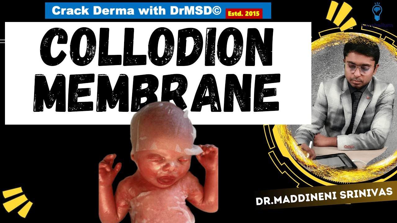 COLLODION MEMBRANE seen in which ICTHYOSIS? | COMMON MISTAKE OF MANY ...