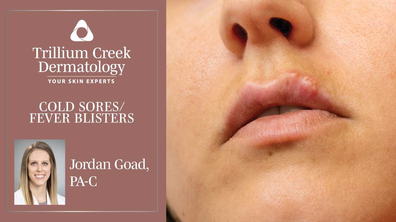 What are cold sores/fever blisters? - YouTube