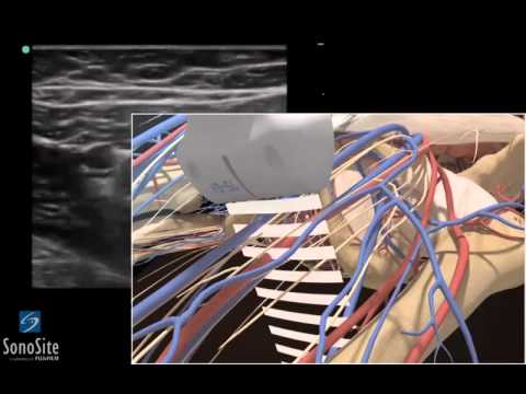 3D Comment: Bloc Nerf Saphène échoguidé - échographe SonoSite - YouTube