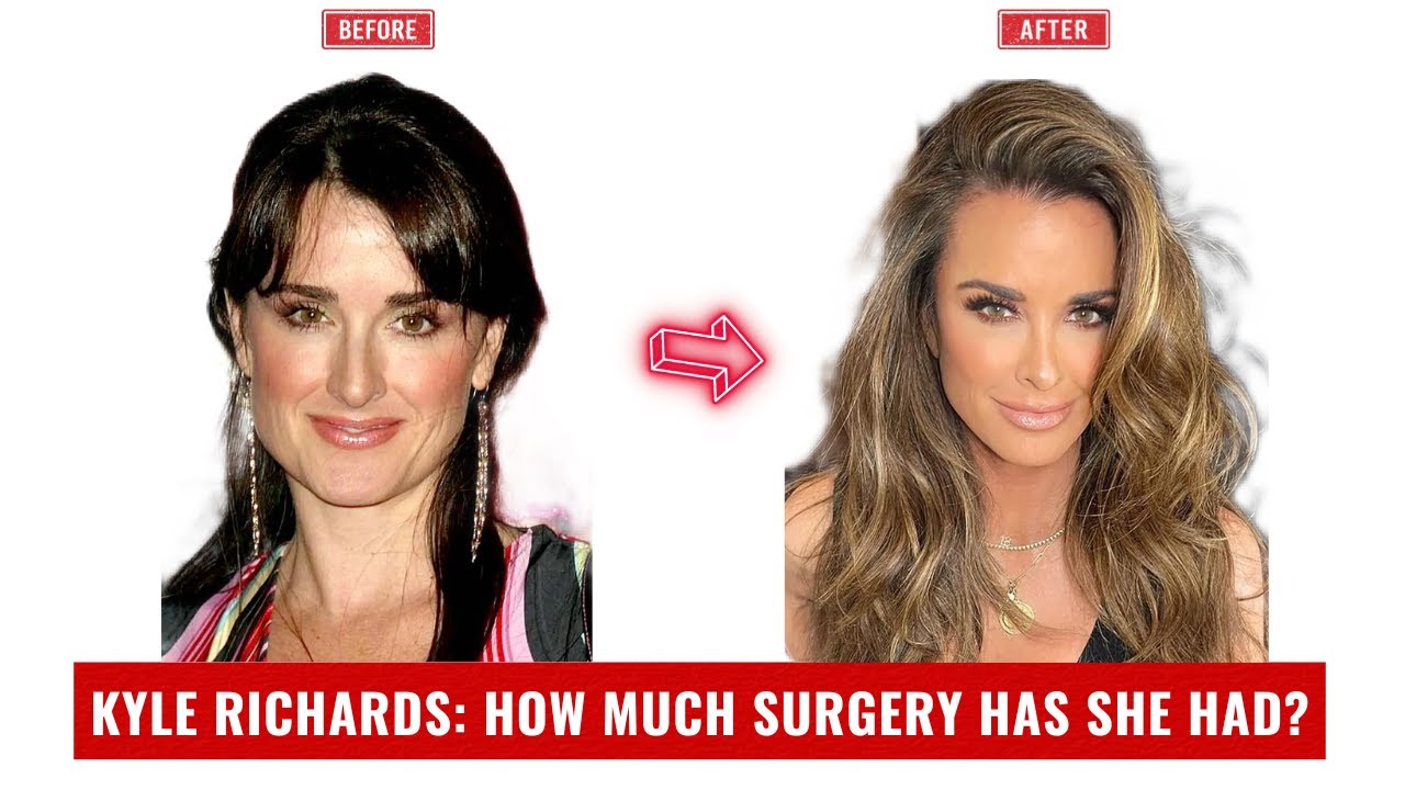 Kyle Richards: Plastic Surgery Analysis! How MUCH Has She Had Done? # ...