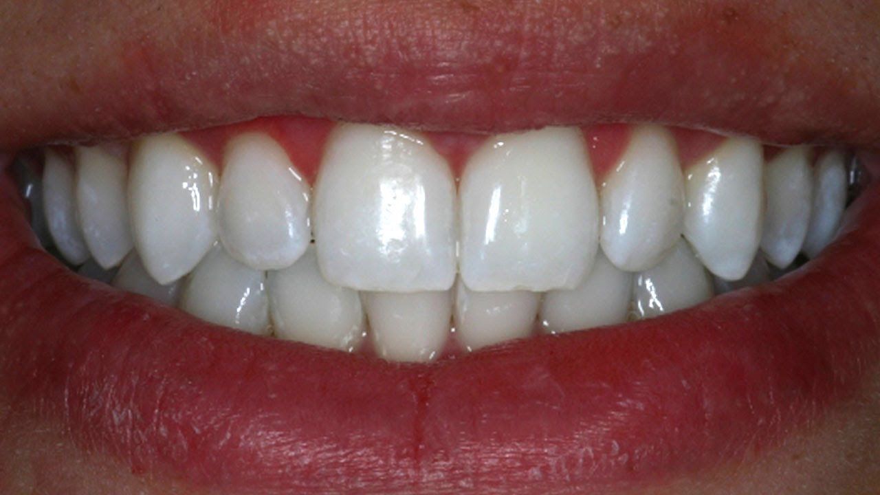 Como Faço Pra Adquirir Comprar Uma PPR Prótese Dentária Parcial ...