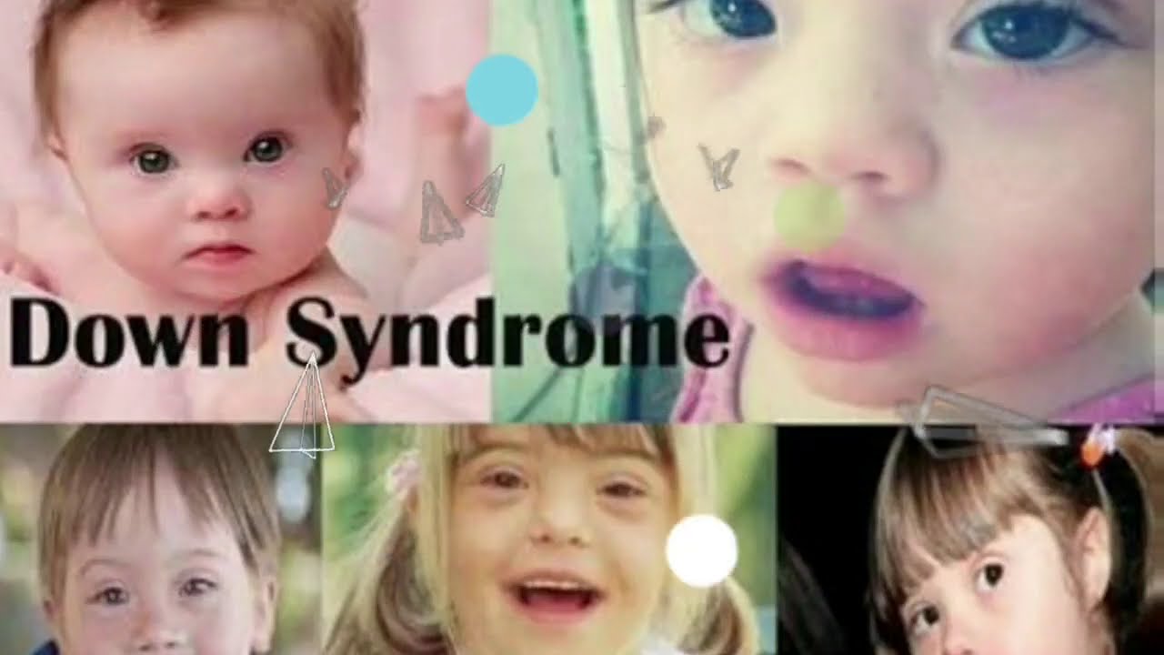 Down syndrome#Trisomy 21#mongolian idiocy..# risk factors DS - YouTube