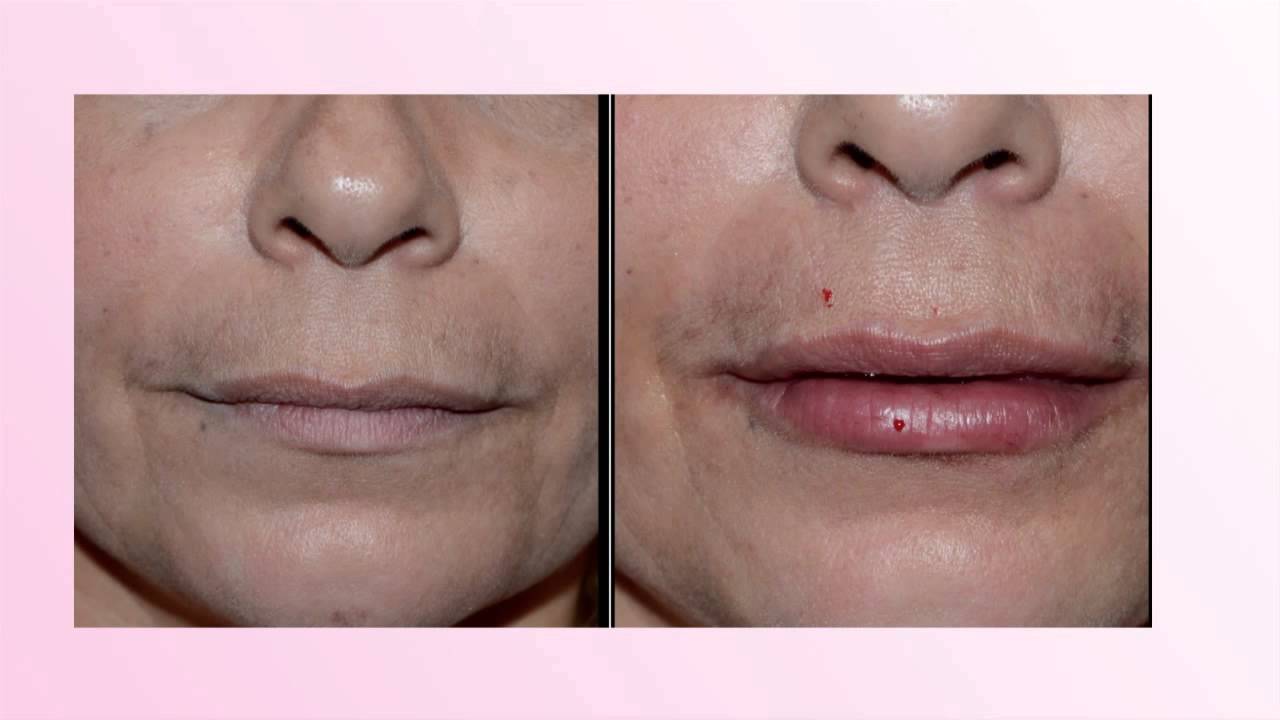 Aumento de labios con Dr. Hector Milla - YouTube