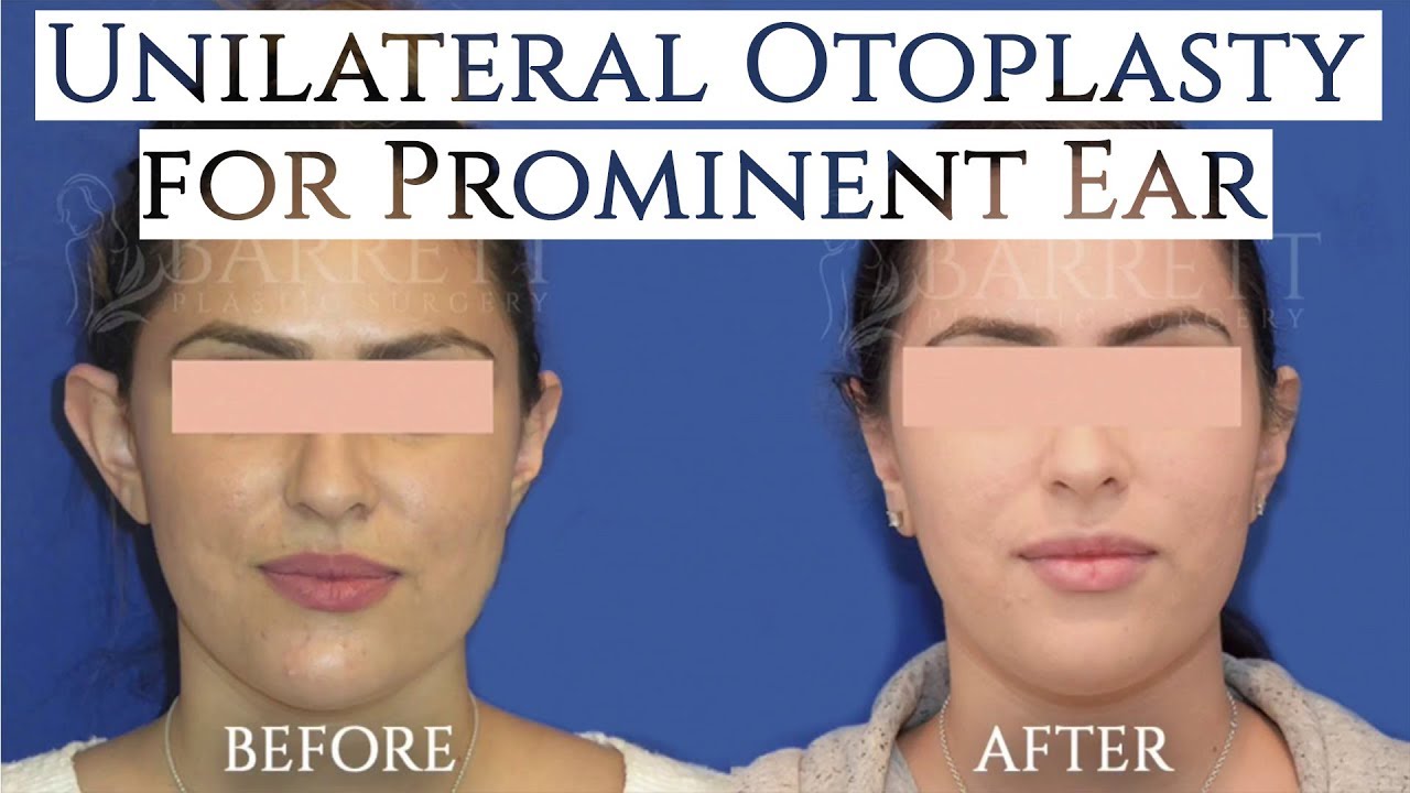 Unilateral Otoplasty for Prominent Ear - YouTube
