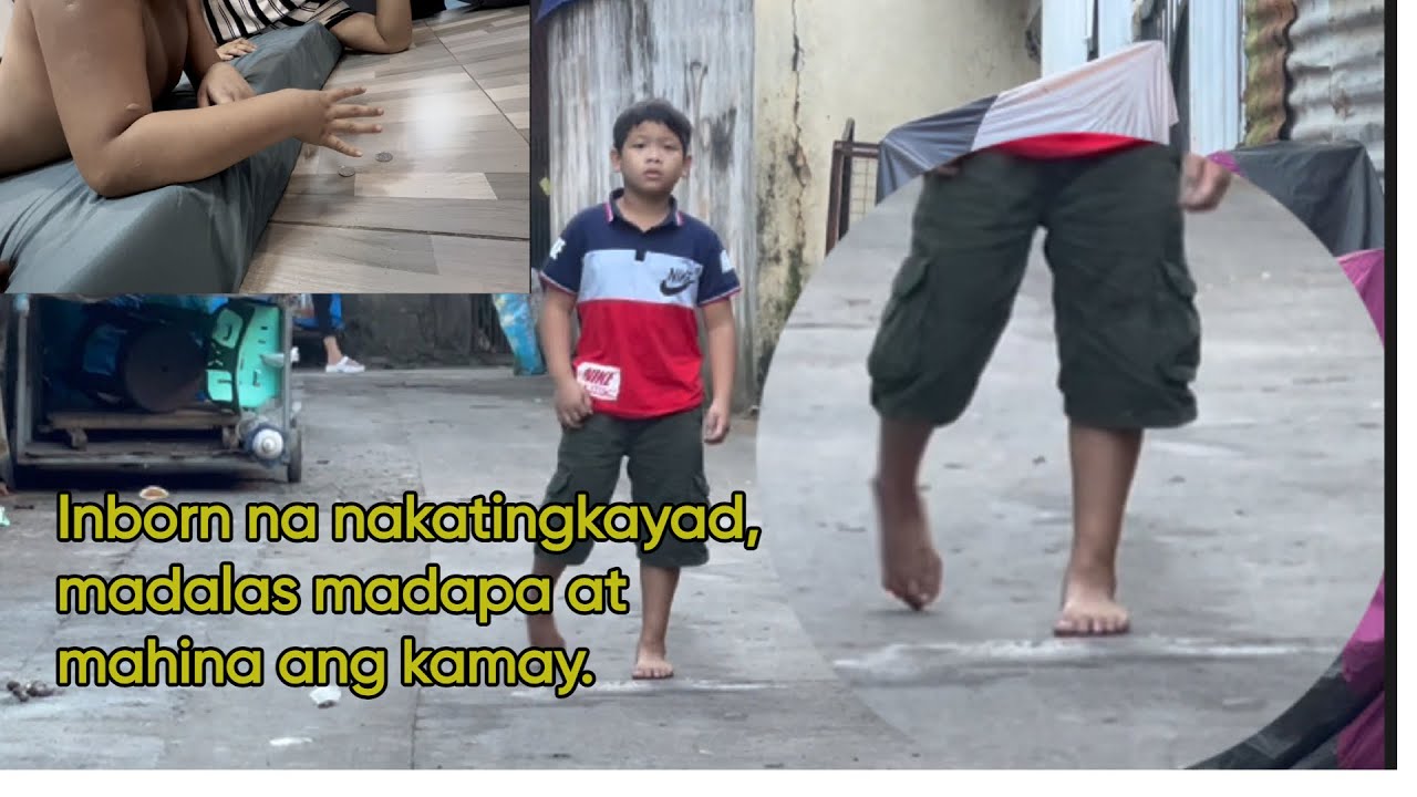 Full video ng Batang inborn na naka tingkayad ,madalas madapa at mahina ...