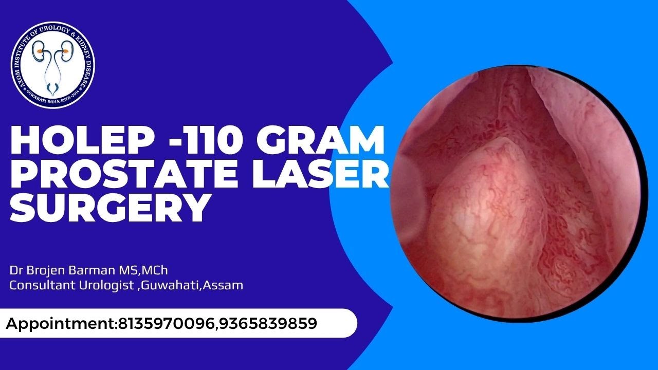 PROSTATE LASER SURGERY | GUWAHATI | DR BROJEN BARMAN MS MCh - YouTube