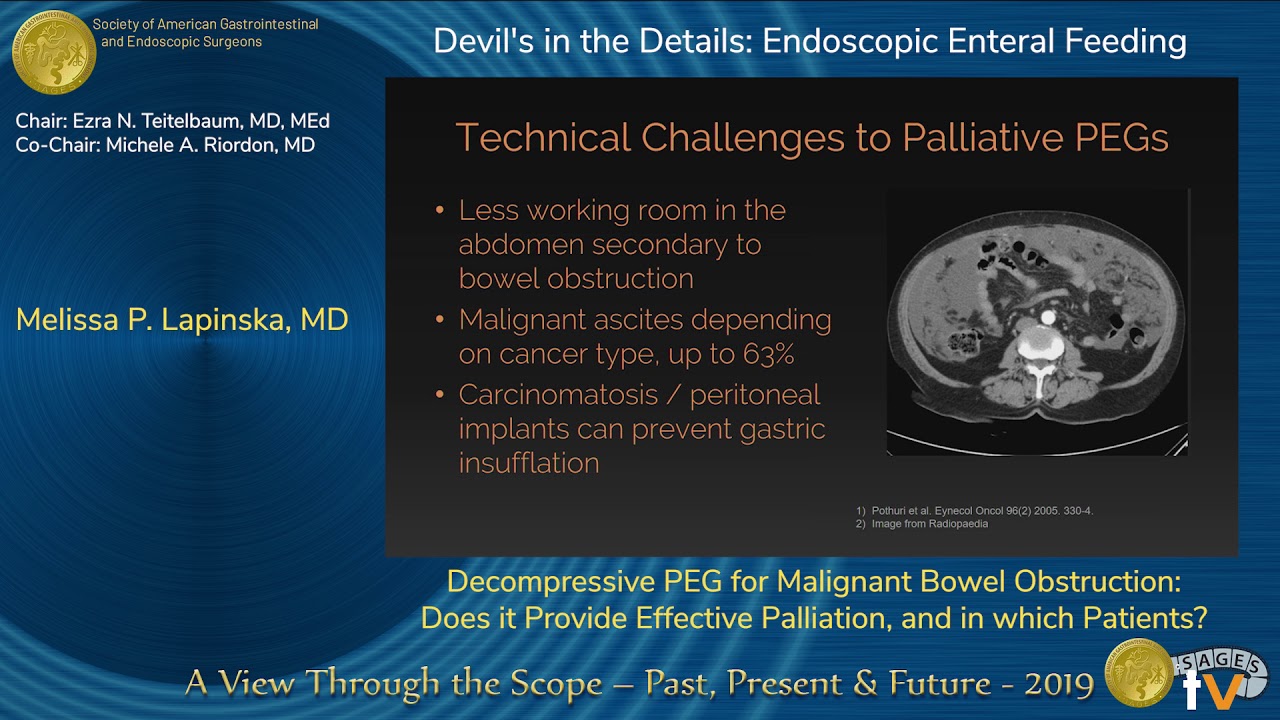 Decompressive PEG for Malignant Bowel Obstruction: Does it Provide ...