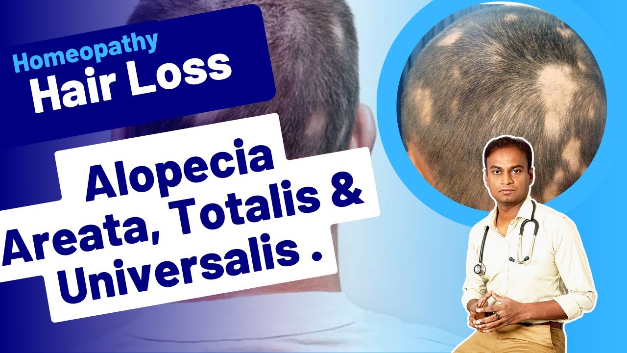 Alopecia Totalis & Universalis: Effective Homeopathic Treatment at ...
