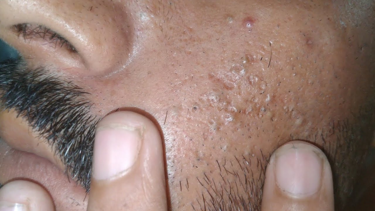 sac be spa blackheads elderly 2024 | sac be spa old age blackheads 2024 ...