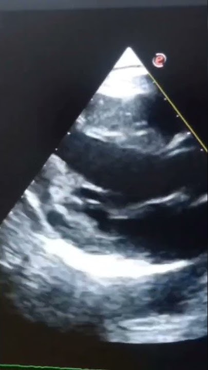 echo cases / assess RWMA #drjahanzaib - YouTube