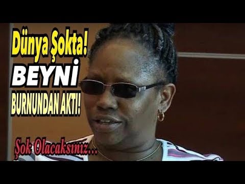 Beyni Burnundan Aktı! Dünya Şokta! Mutlaka İzleyin