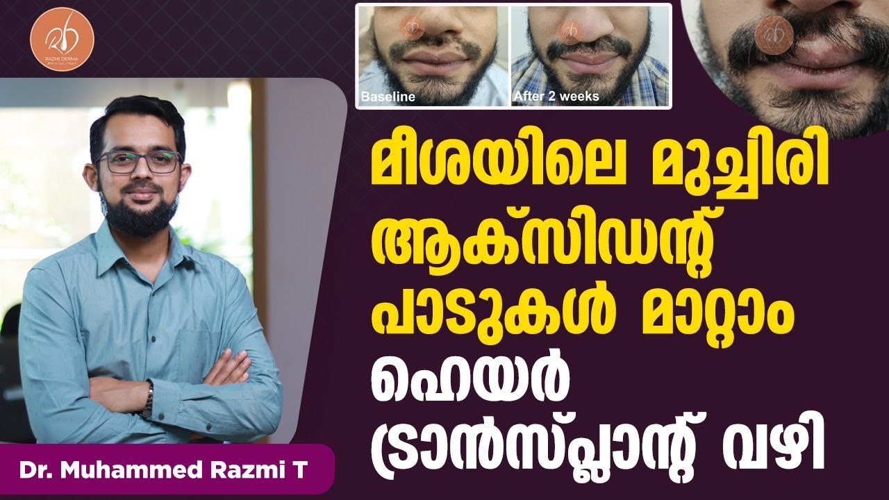 മീശയിലെ മുച്ചിരി/ആക്‌സിഡന്റ് പാടുകൾ ഹെയർ ട്രാൻസ്പ്ലാന്റ് വഴി മാറ്റാം ...