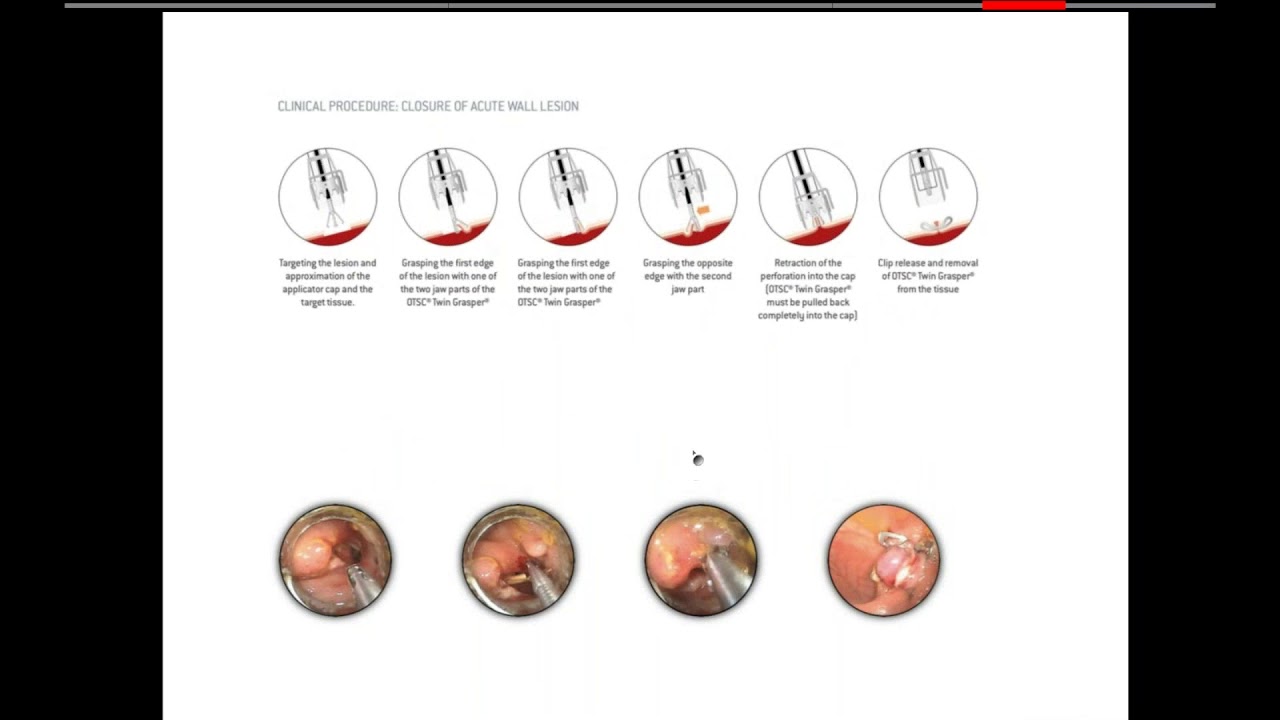 STR Cardiothoracic Case Webinar 1/10/2019 - YouTube