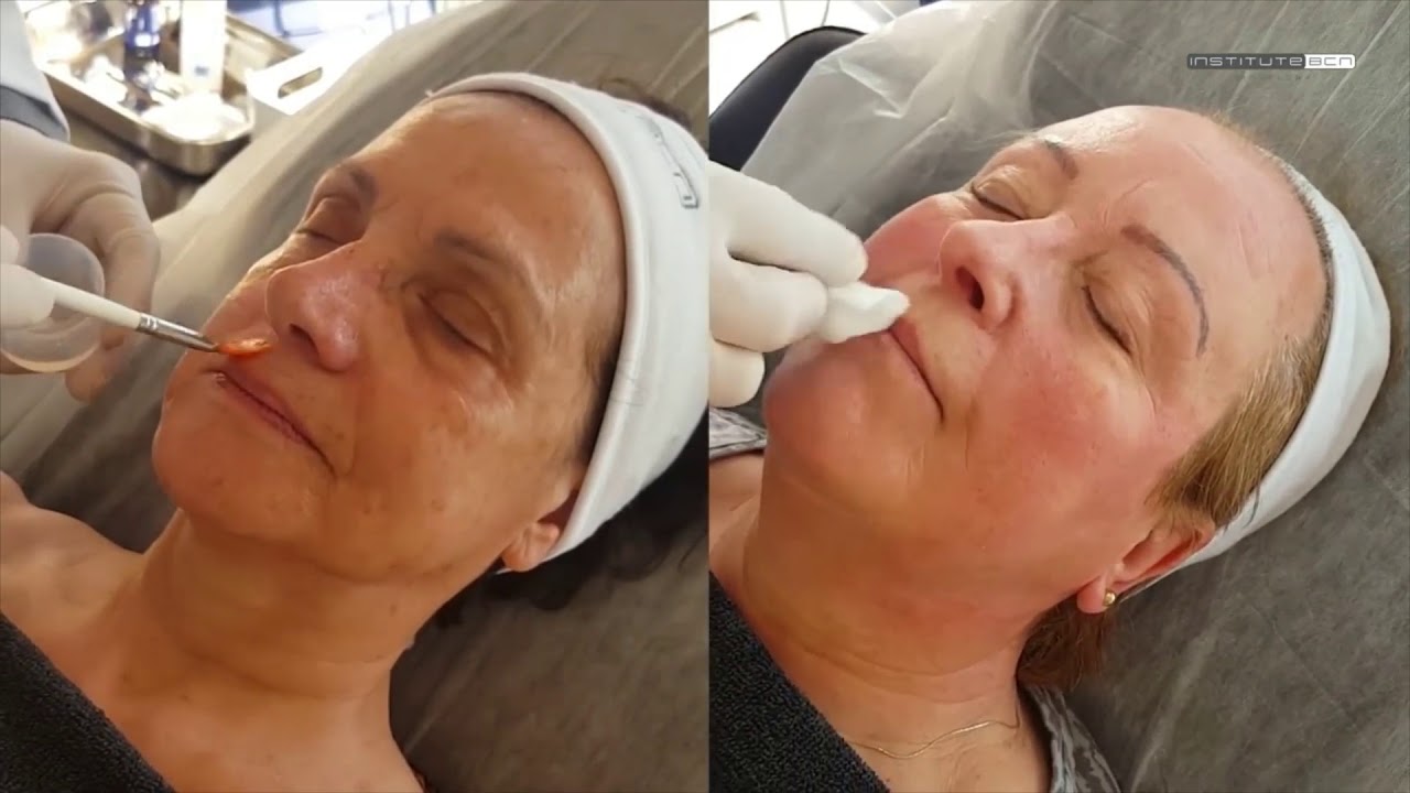 BCN Peel procedure - YouTube