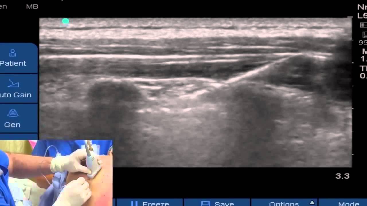 Ultrasound-Guided Paravertebral Block - YouTube