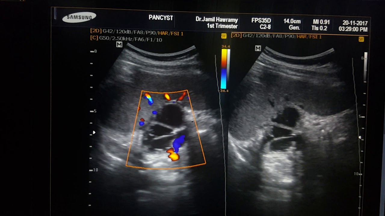 Pancreatic Tail Cystic Lesion US - YouTube