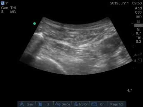 Ultrasound guided subgluteal sciatic nerve block - YouTube