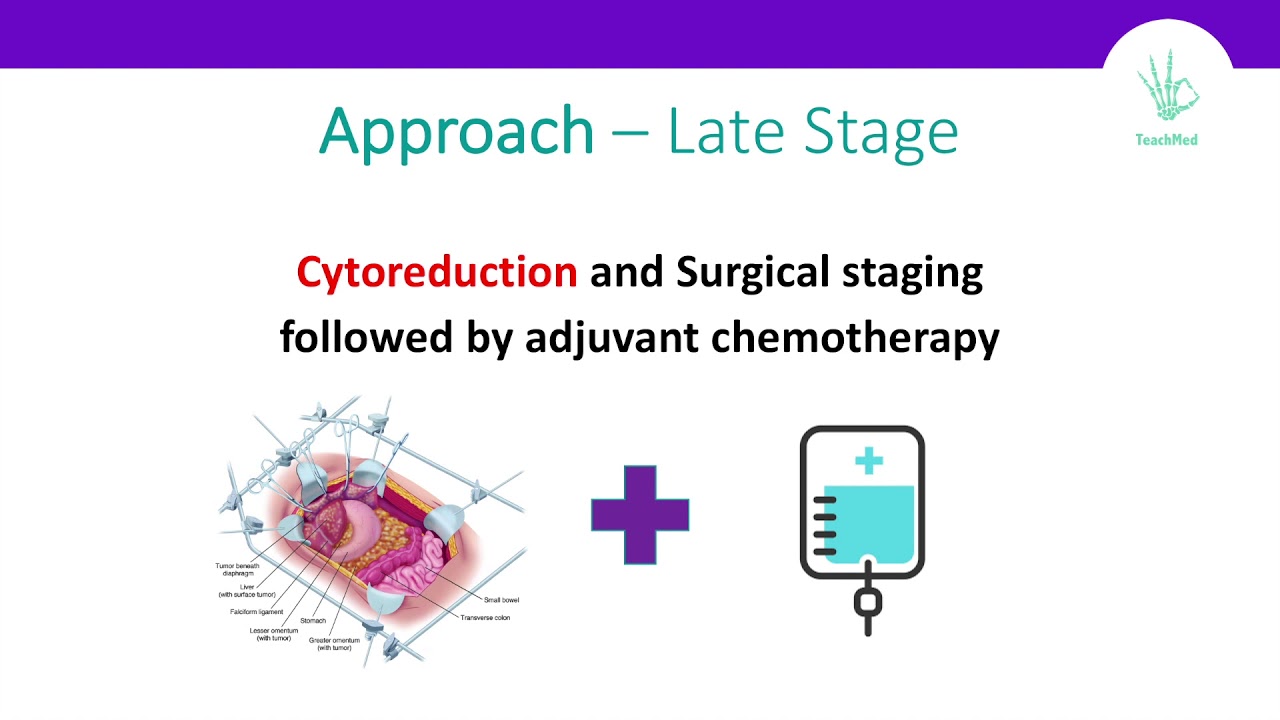 Ovarian Cancer Management – Basic Understanding - YouTube