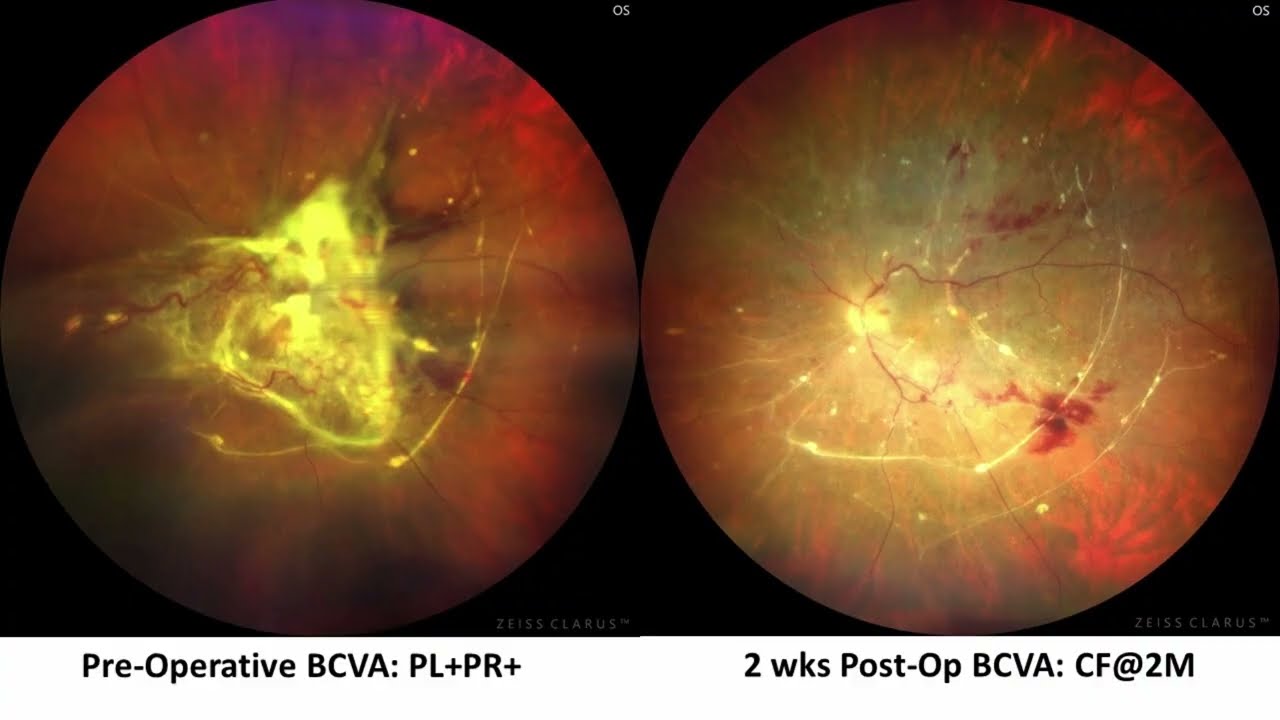 PDR-Table Top TRD: Bimanual Dissection with Vitrectomy cutterCutter ...