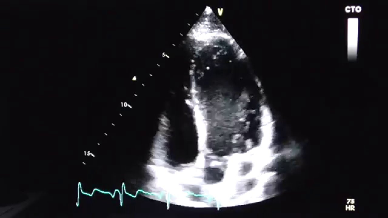 Apikaler 5-Kammerblick (apical 5 chamber view) - YouTube