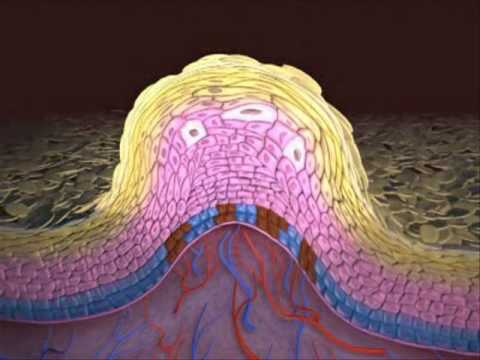 Genital Warts (HPV - Movie) - YouTube