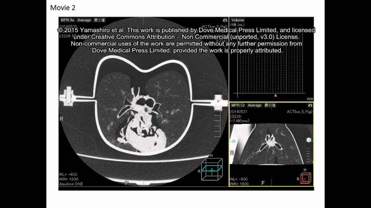 Continuous airway measurement on dynamic ventilation CT - Supplementary ...