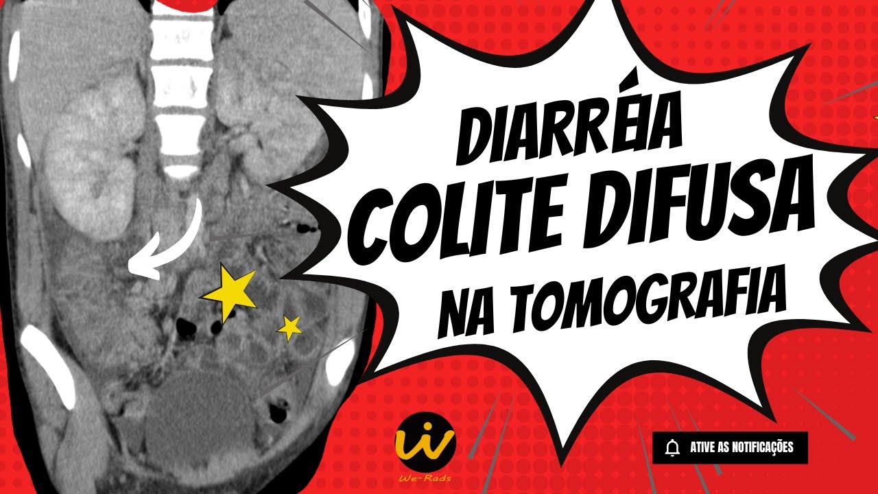 DIARRÉIA - COLITE DIFUSA na Tomografia de abdome e pelve - YouTube