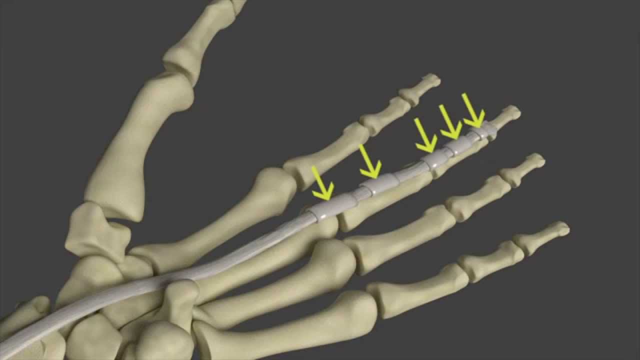 Trigger Finger: Symptoms and Anatomy - YouTube