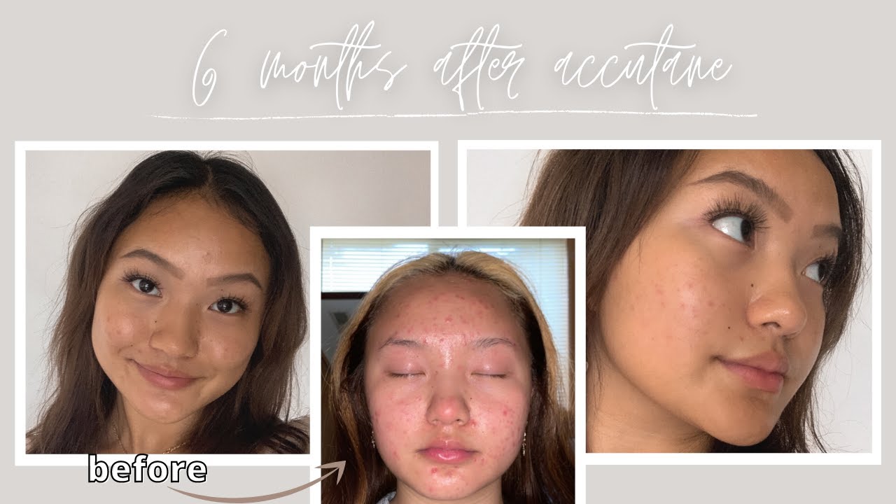 6 MONTHS POST-ACCUTANE - YouTube