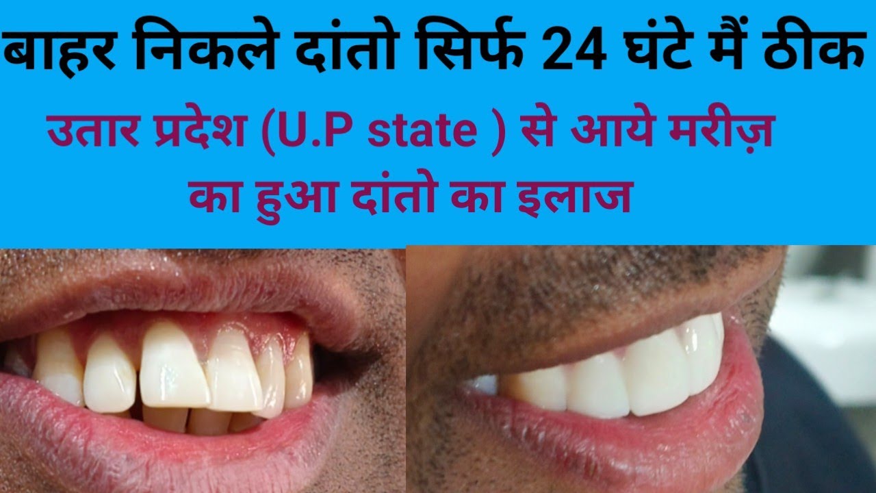 उतार प्रदेश (U.P State) से आये मरीज़ का हुआ बाहर निकले दांतों का इलाज ...