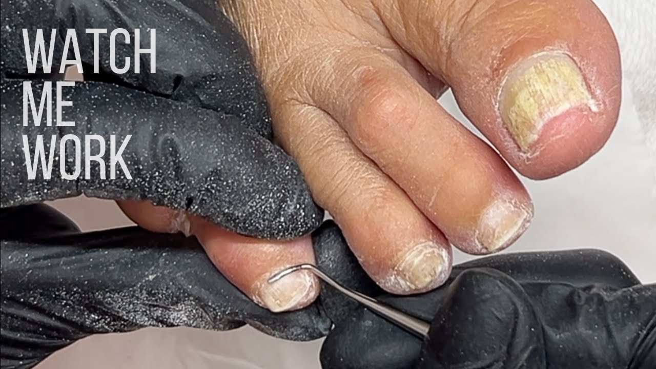 Gentle salon pedicure for mature feet. Involuted nails cut too short ...