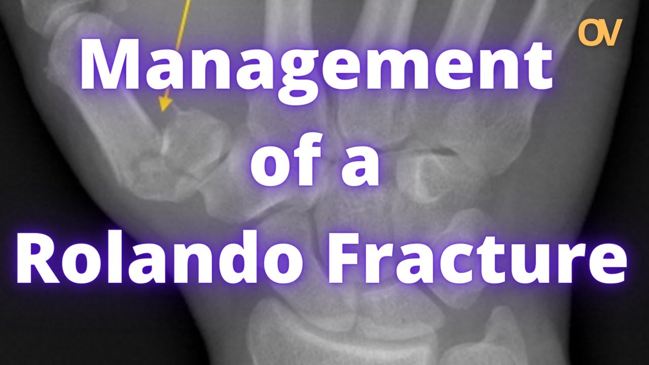 Management of a Rolando Fracture - YouTube