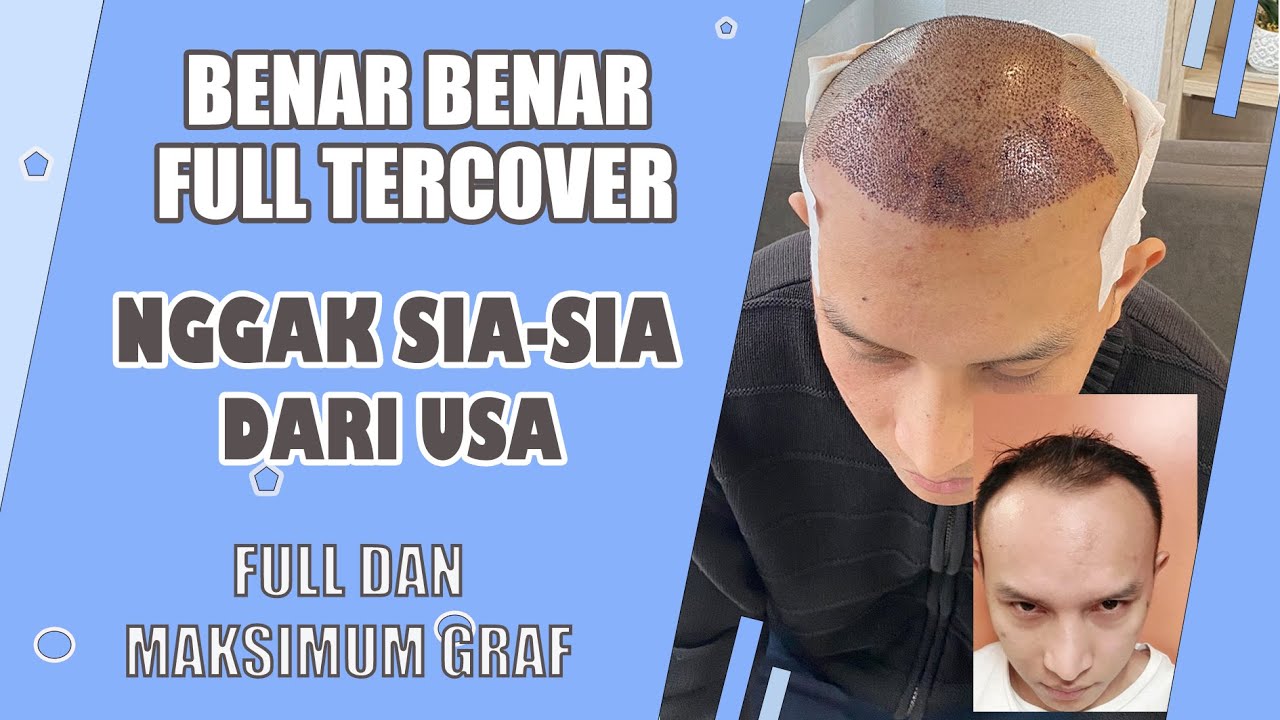 tanam rambut hair transplant , hasil nya full tercover udah pasti bagus ...