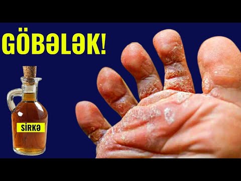 Ayaq Barmaqları Qaşınanlar MÜTLƏQ İZLƏSİN! - SİRKƏLİ SU GÖBƏLƏYİ YOX EDİR?