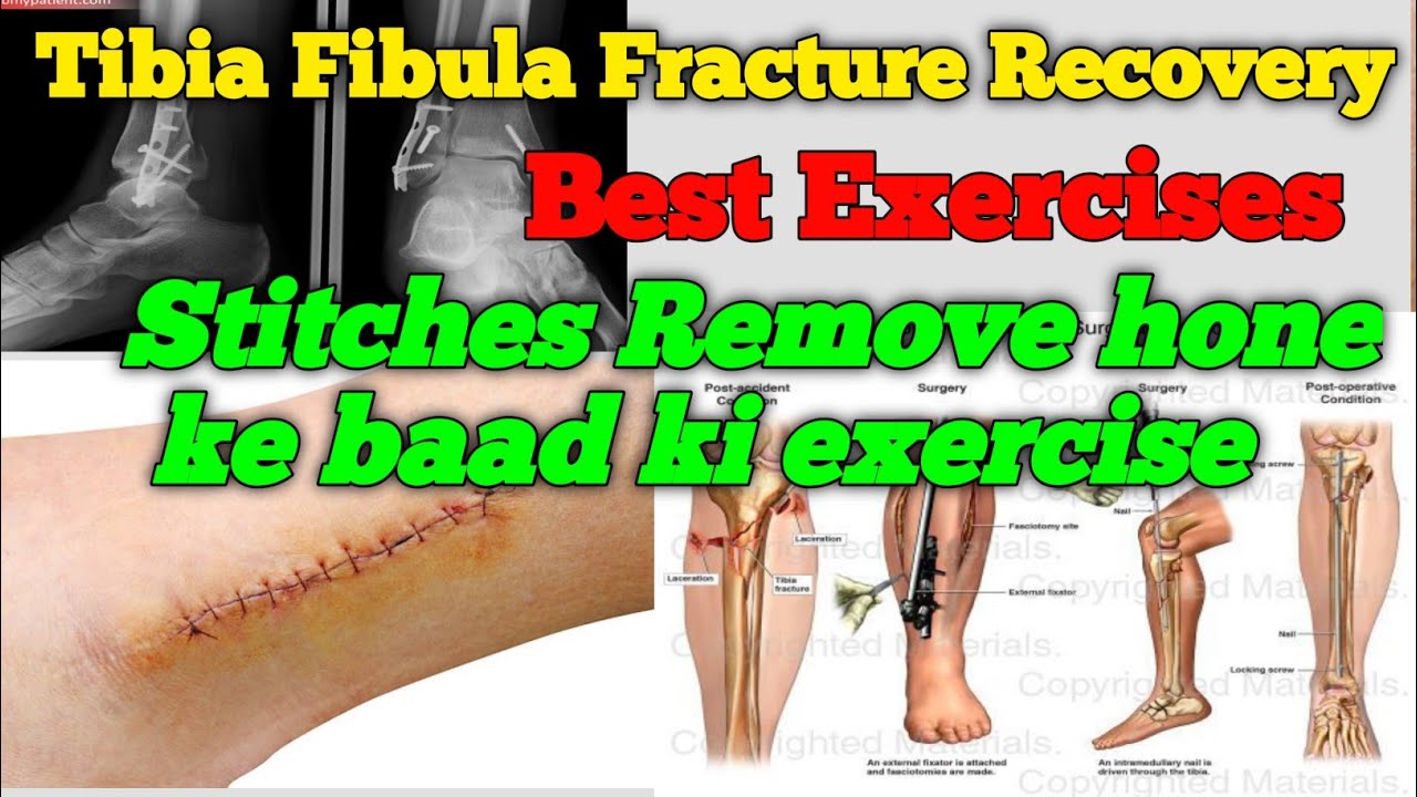 Tibia Fibula Fracture Recovery Exercise। फ्रैक्चर के बाद इस एक्सरसाइज ...