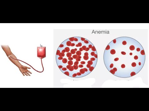 Perioperative anemia – management strategies | Dr.S.Parthasarathy MD ...