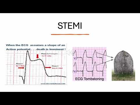 VOPP Acute Coronary Syndrome - YouTube