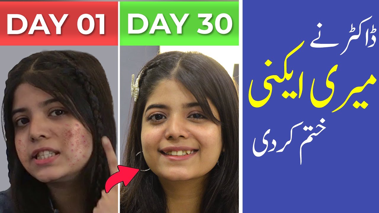 My 30 Day Acne Scars Transformation - Before/After Insane Results - YouTube