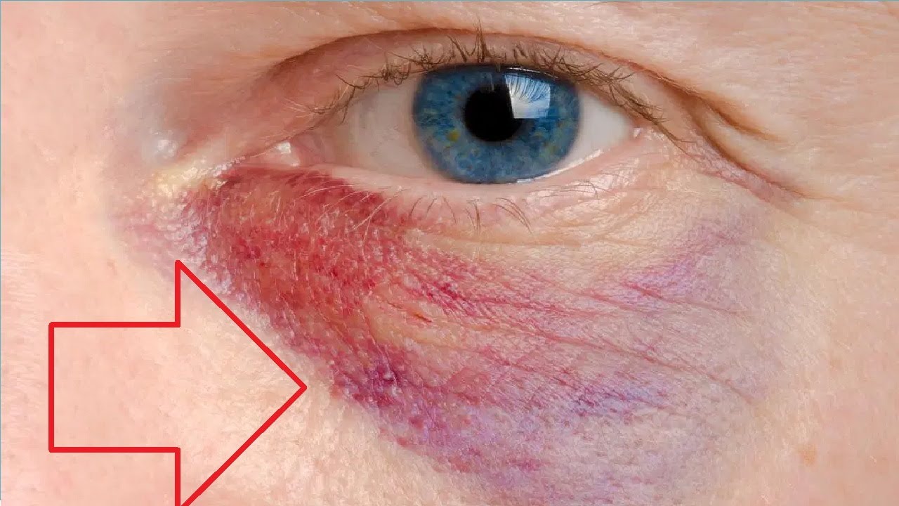 how to get rid of a black eye with toothpaste - YouTube