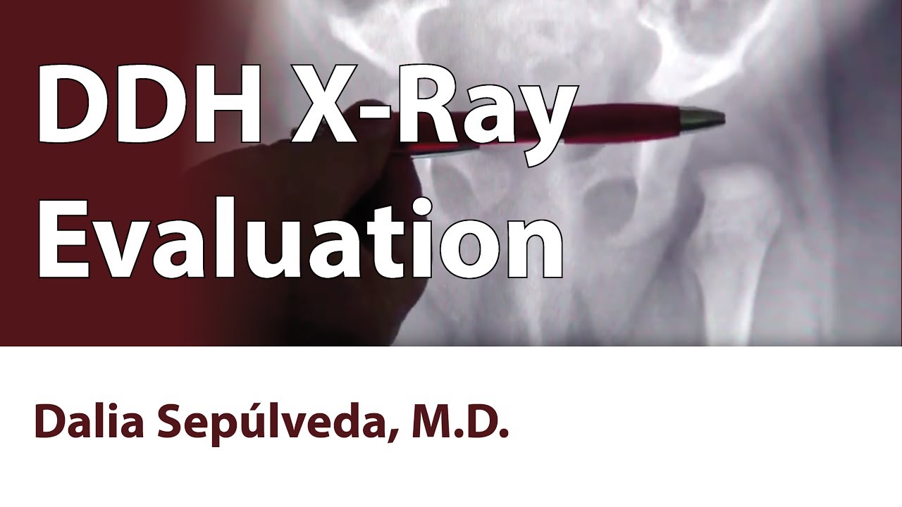DDH X-Ray Evaluation - YouTube