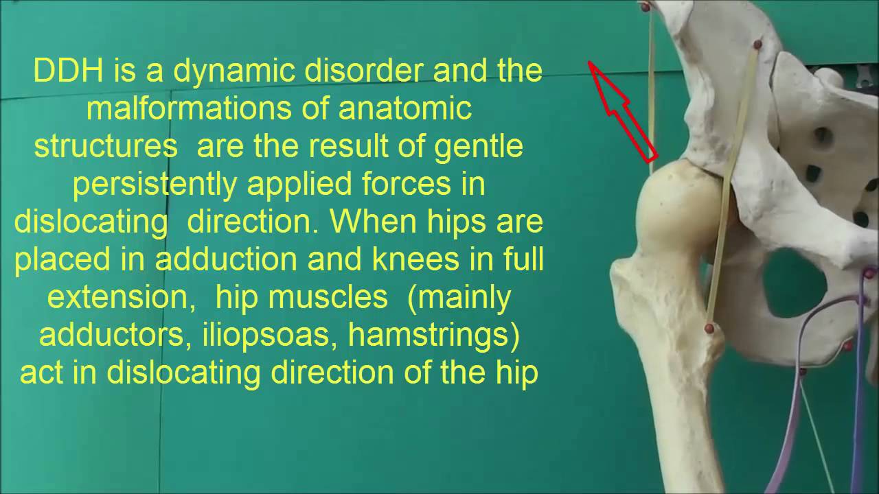 Dislocation of the femoral head in developmental dysplasia of the hip ...