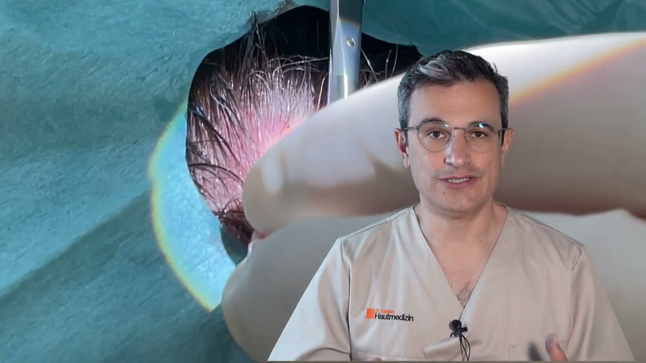 Talgzyste am Kopf, kahle Stelle durch Atherom. Dr. Kasten Hautmedizin ...