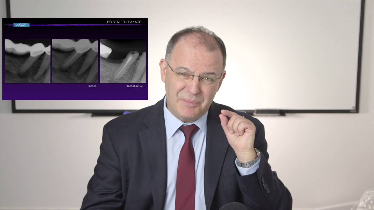 Coronal Leakage Prevention with Bonded Obturation? (Dr. Alex Fleury ...