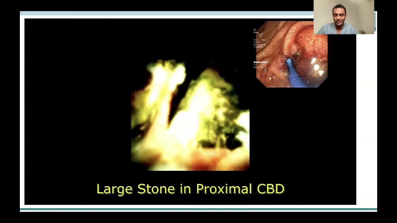 Management of a large CBD stone in a failed prior ERCP - YouTube