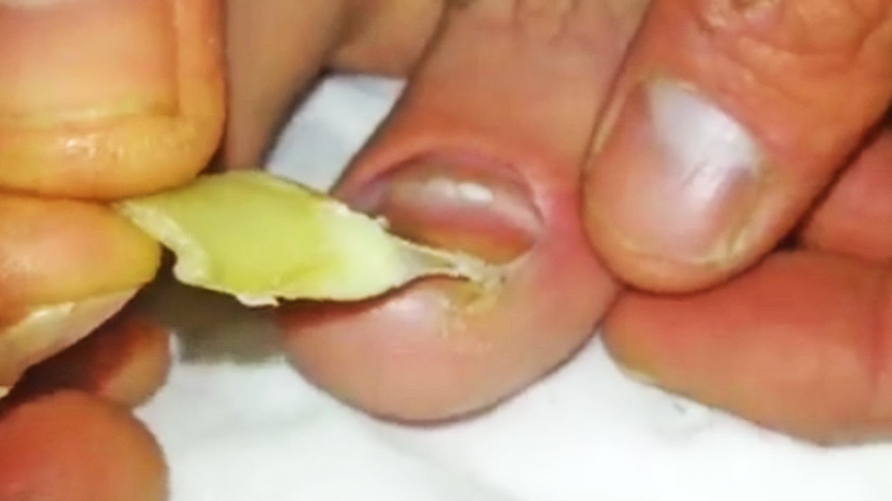 Ingrown Toenails! How To Prevent Ingrown Nails - YouTube