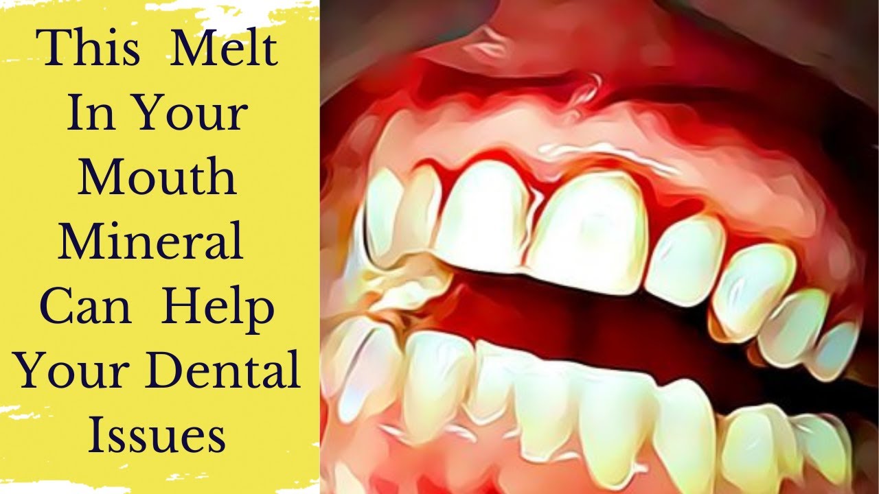 This Melt In Your Mouth Mineral Can Help Your Dental Issues - YouTube