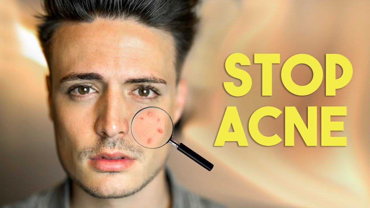 Stop Acne FAST! 5 Steps to beating acne FOREVER - YouTube