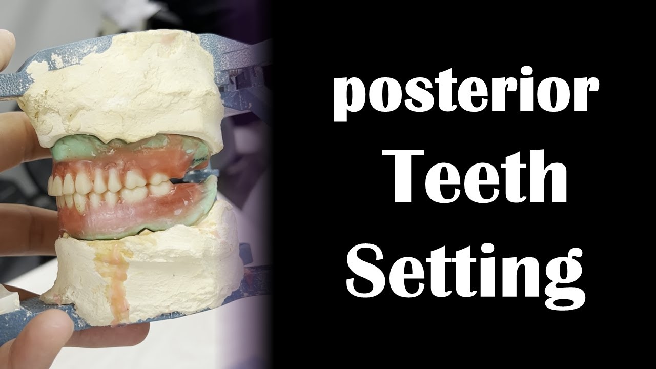 Posterior Teeth Setting - YouTube