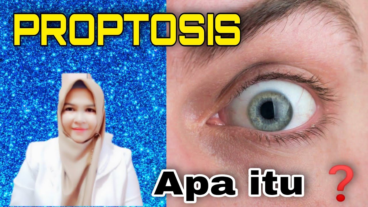 Bola Mata Menonjol proptosis •| Pengertian, Gejala, Penyebab, dan ...