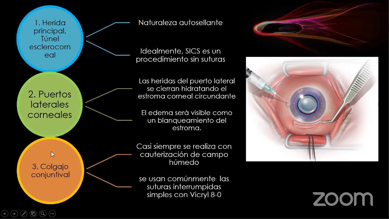 Cirugía de catarata extracapsular (ECCE) y Cirugía de cataratas con ...